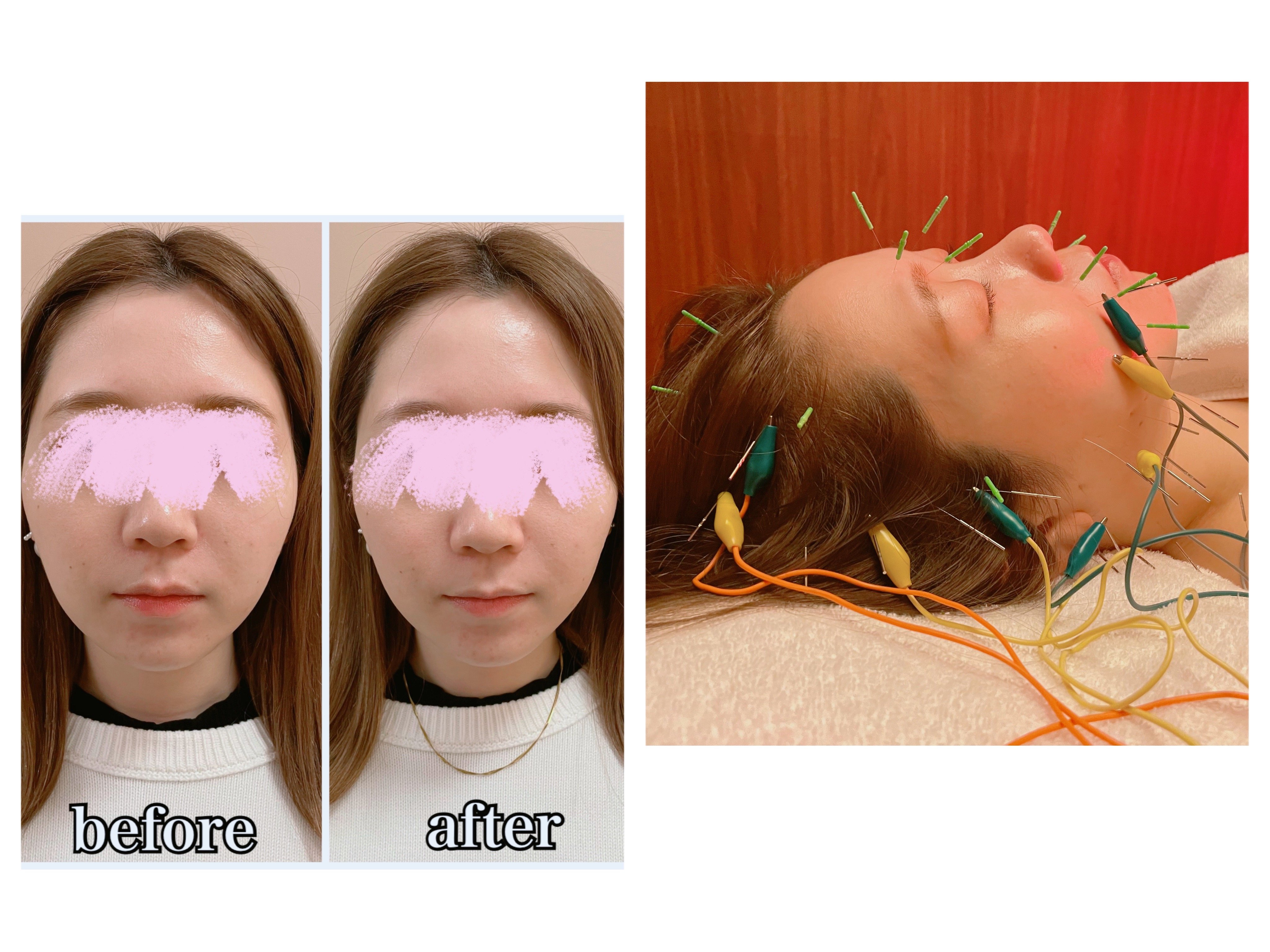 美容鍼の効果って？痛みはあるの？ライターが実際にやってみたbefore/afterをご紹介 | arweb（アールウェブ）