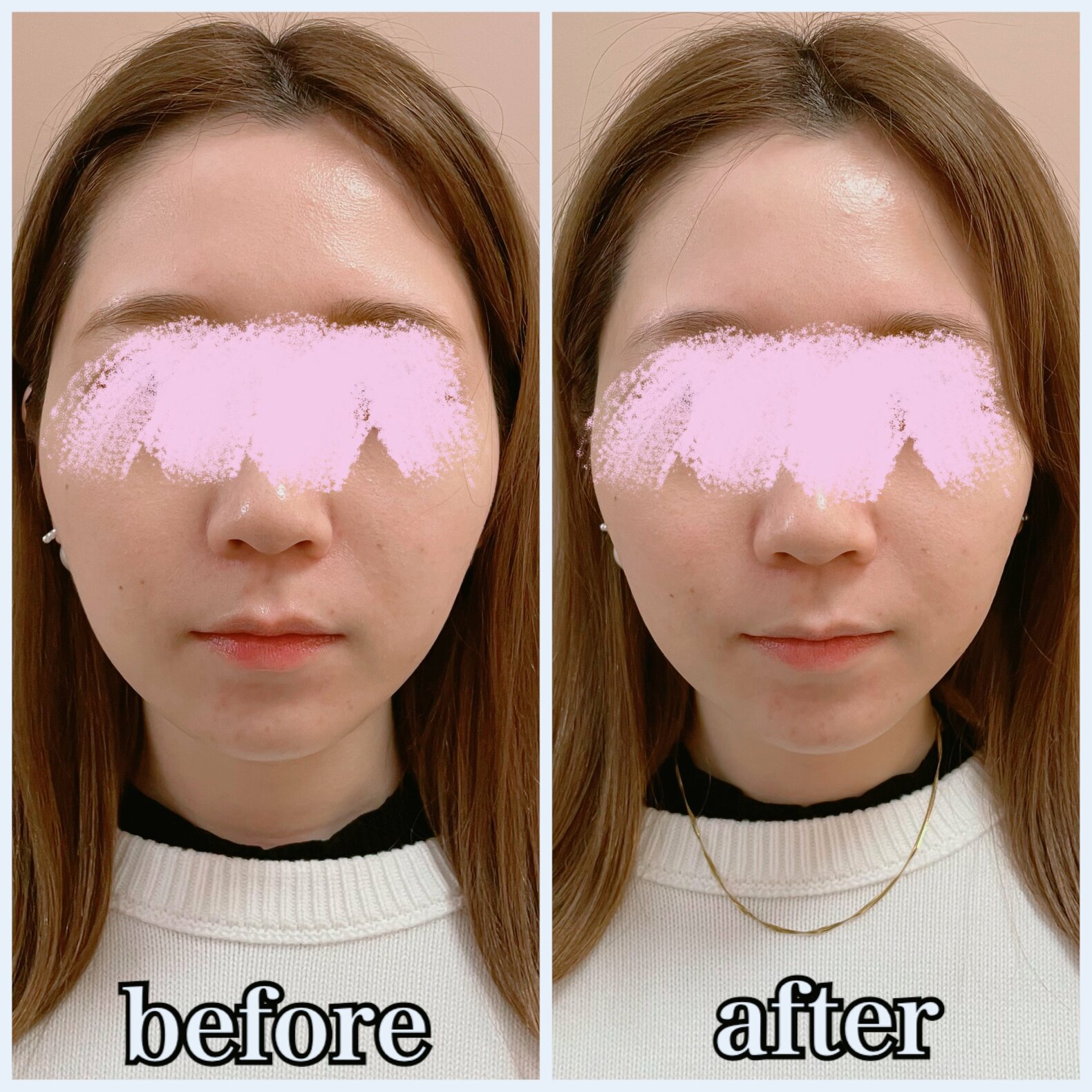 美容鍼の効果って？痛みはあるの？ライターが実際にやってみたbefore/afterをご紹介 | arweb（アールウェブ） | 3ページ目 | 大好きな人にモテるための髪型・メイク ...